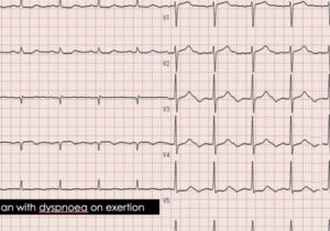 inverted U wave Archives - Resus